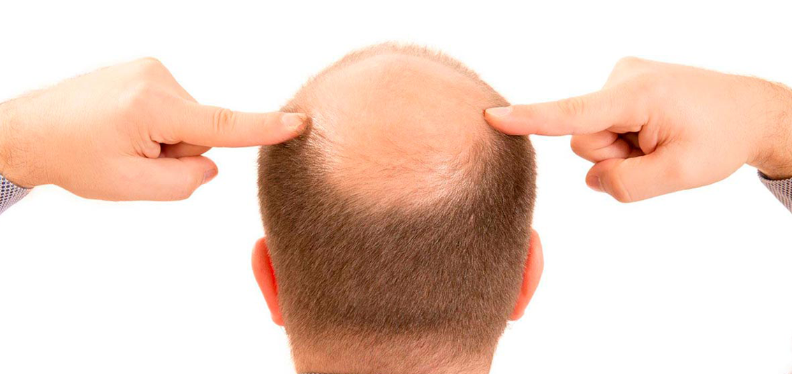 Microagulhamento Capilar - Rãmaga Pro-Estética