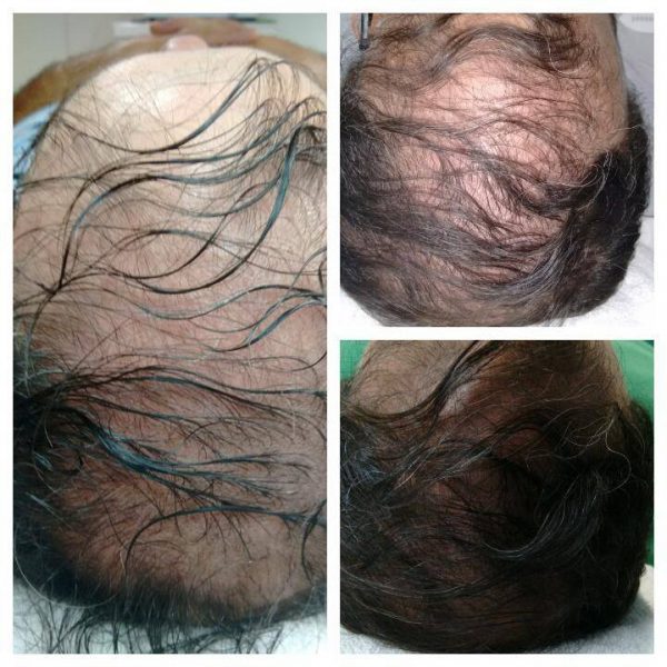 Microagulhamento por Infusão na Terapia Capilar - Rãmaga Pro-Estética