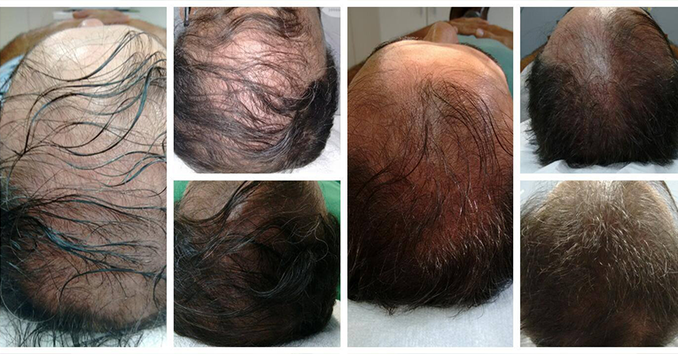 Microagulhamento por Infusão na Terapia Capilar - Rãmaga Pro-Estética