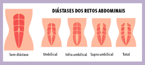 Diástase abdominal: Tem tratamento? - Rãmaga Pro-Estética