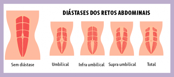 Diástase abdominal: Tem tratamento? - Rãmaga Pro-Estética